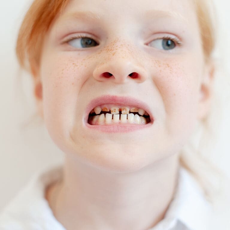 Hypoplastic tooth enamel treatment | Pediatric Dentist Southwest Ranches FL